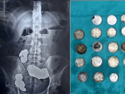 Homem engole moedas para aumentar quantidade de zinco no corpo